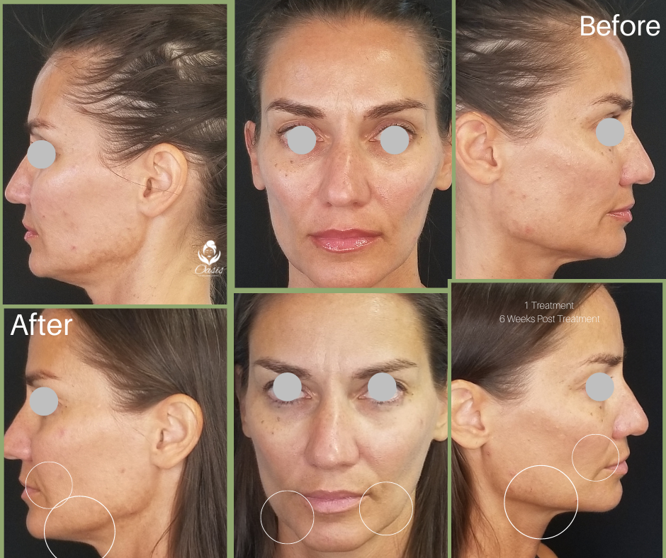 Procell Microchanneling | Oasis Skin & Wellness Clinic Inc.